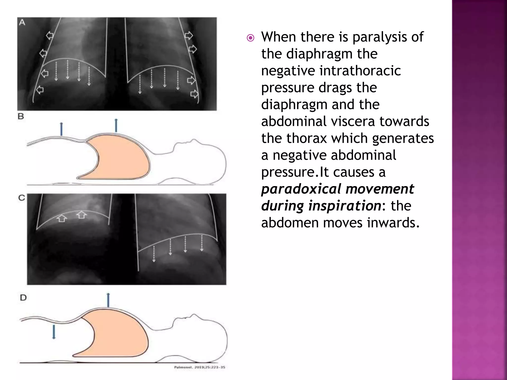 Diaphragmatic Disorders | PPTX