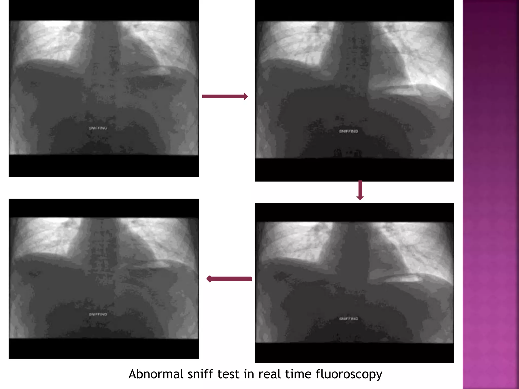 Diaphragmatic Disorders | PPTX