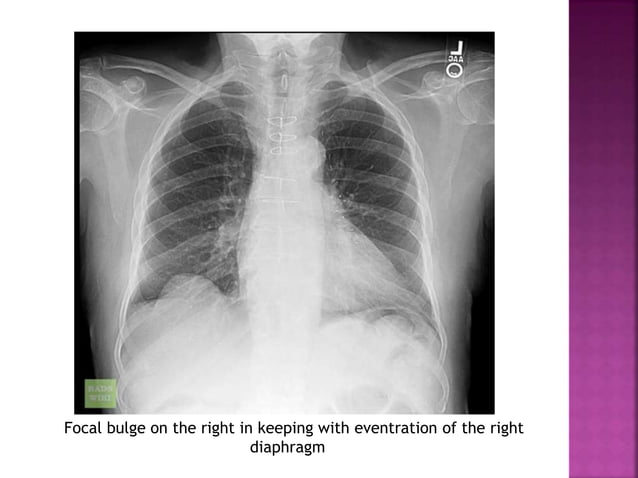 Diaphragmatic Disorders | PPTX