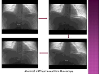 Diaphragmatic Disorders | PPTX