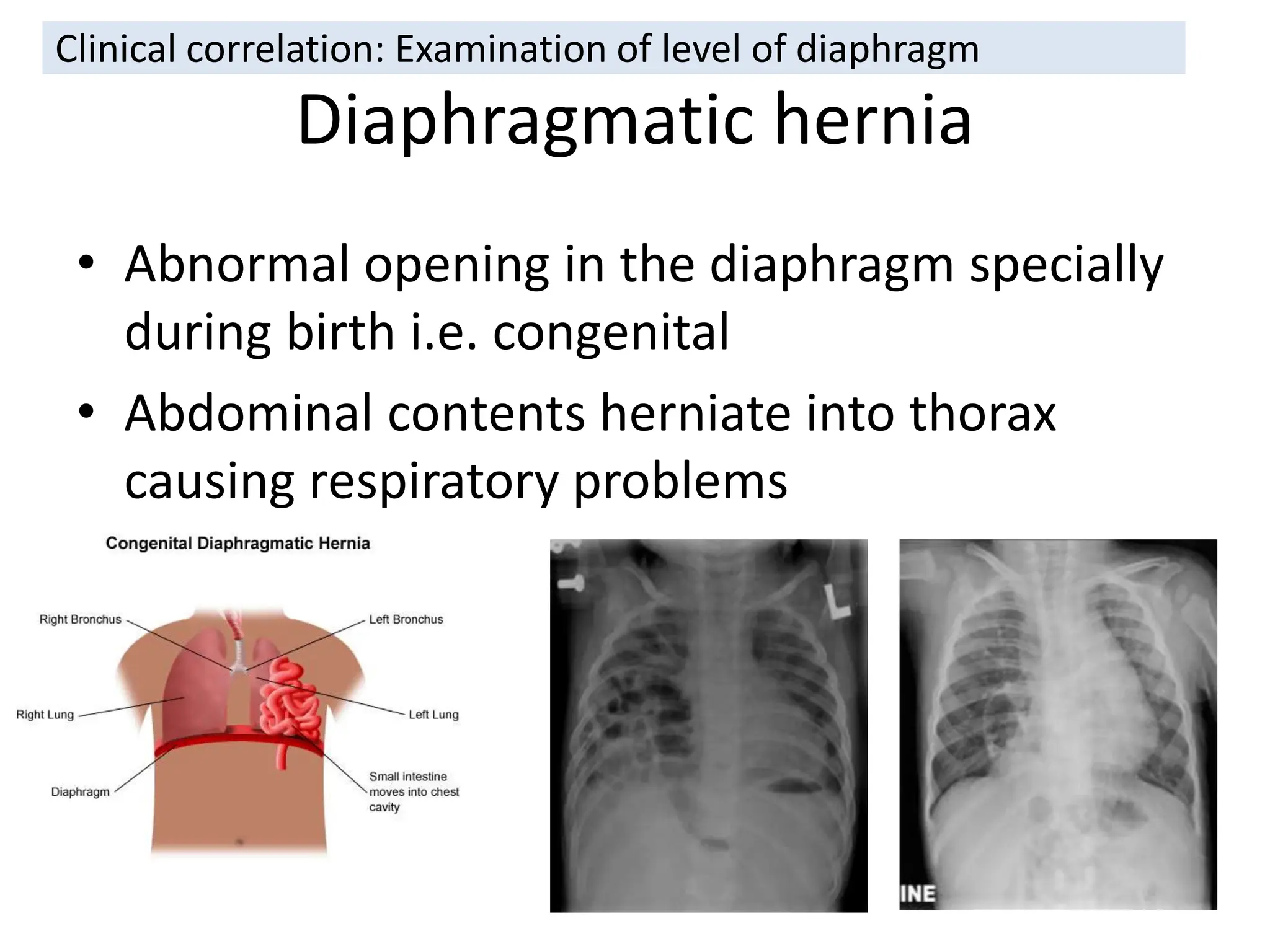 Diaphragm.pptx