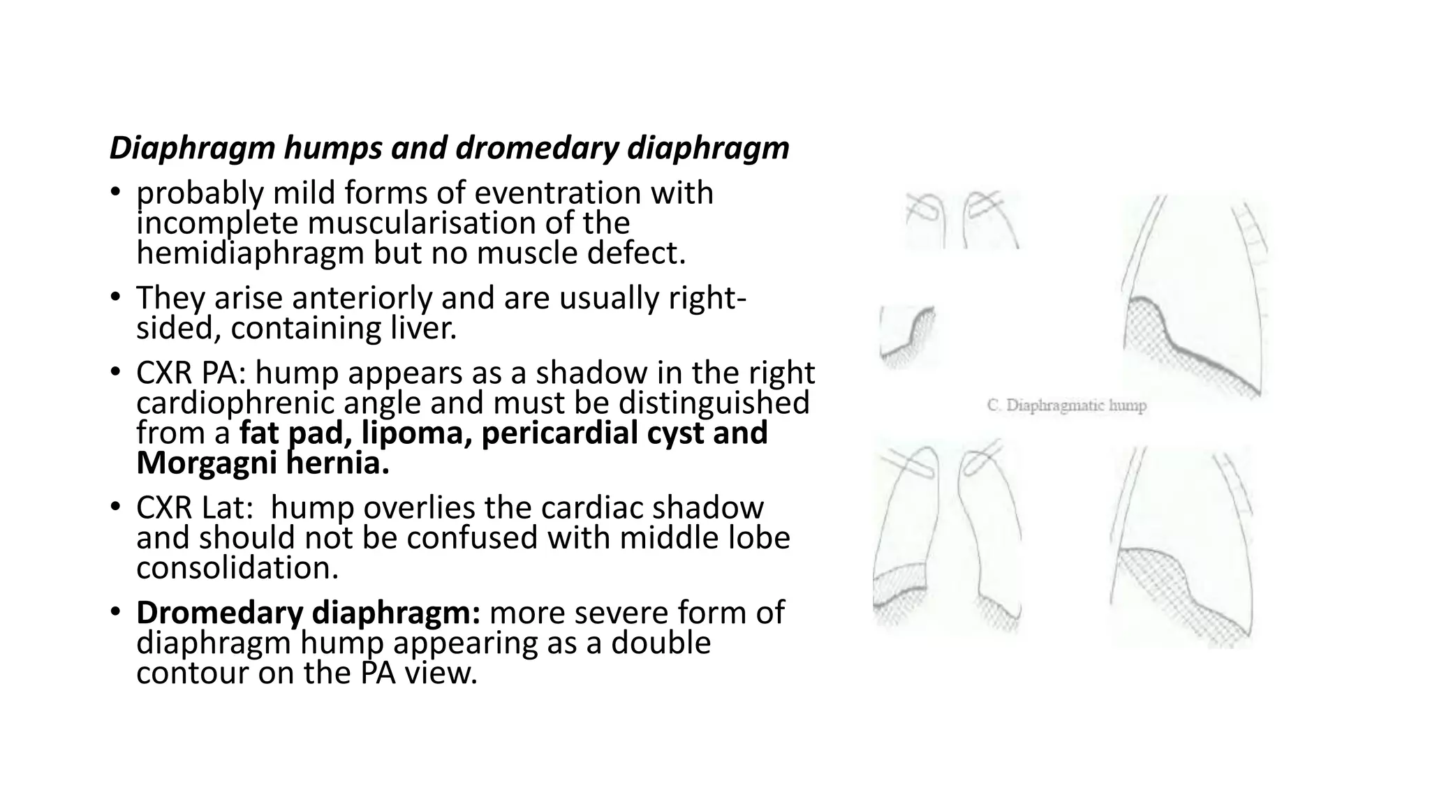 Imaging of diaphragm and its pathologies by Dr. Milan | PPTX