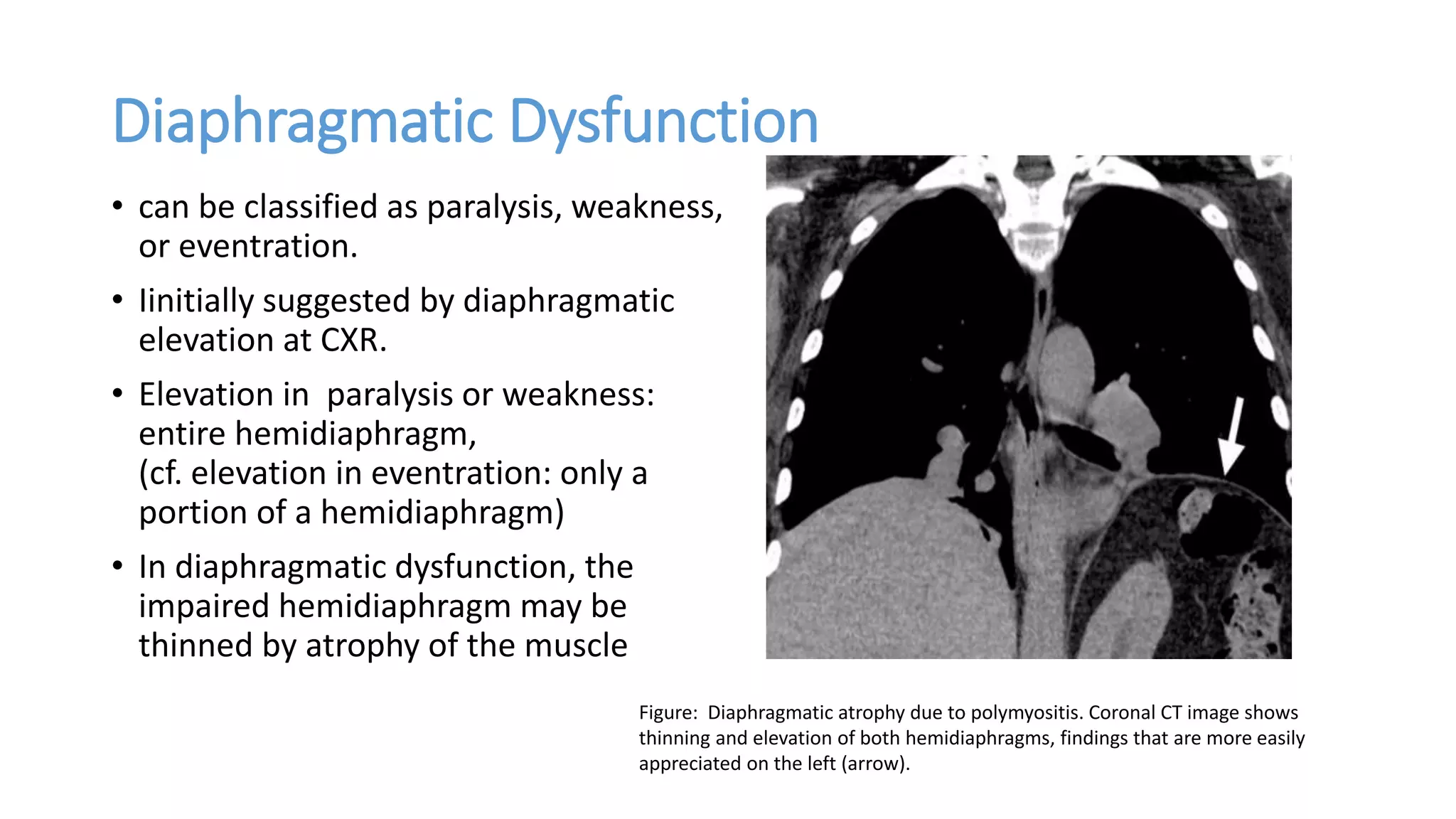 Imaging of diaphragm and its pathologies by Dr. Milan | PPTX