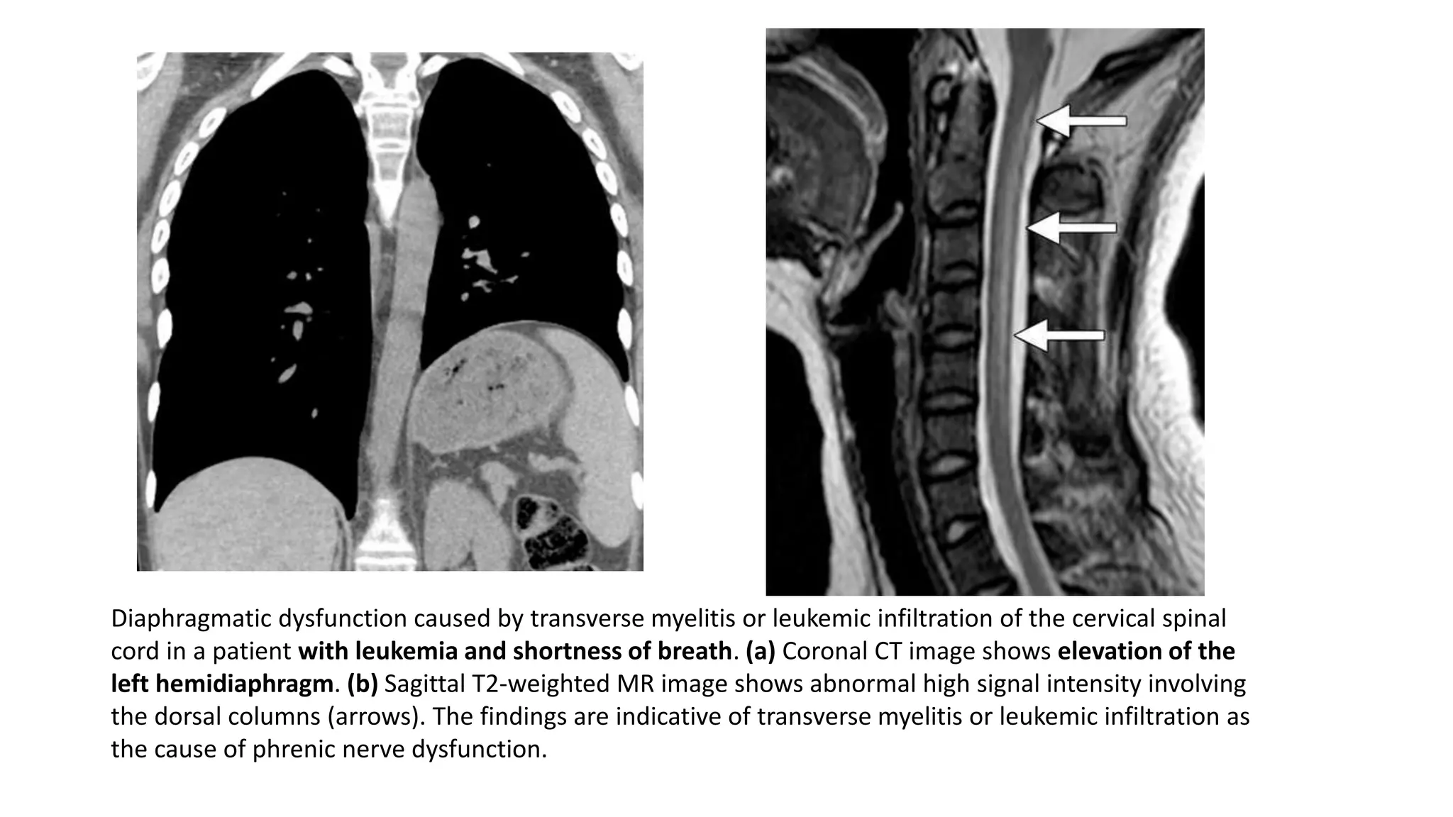 Imaging of diaphragm and its pathologies by Dr. Milan | PPTX