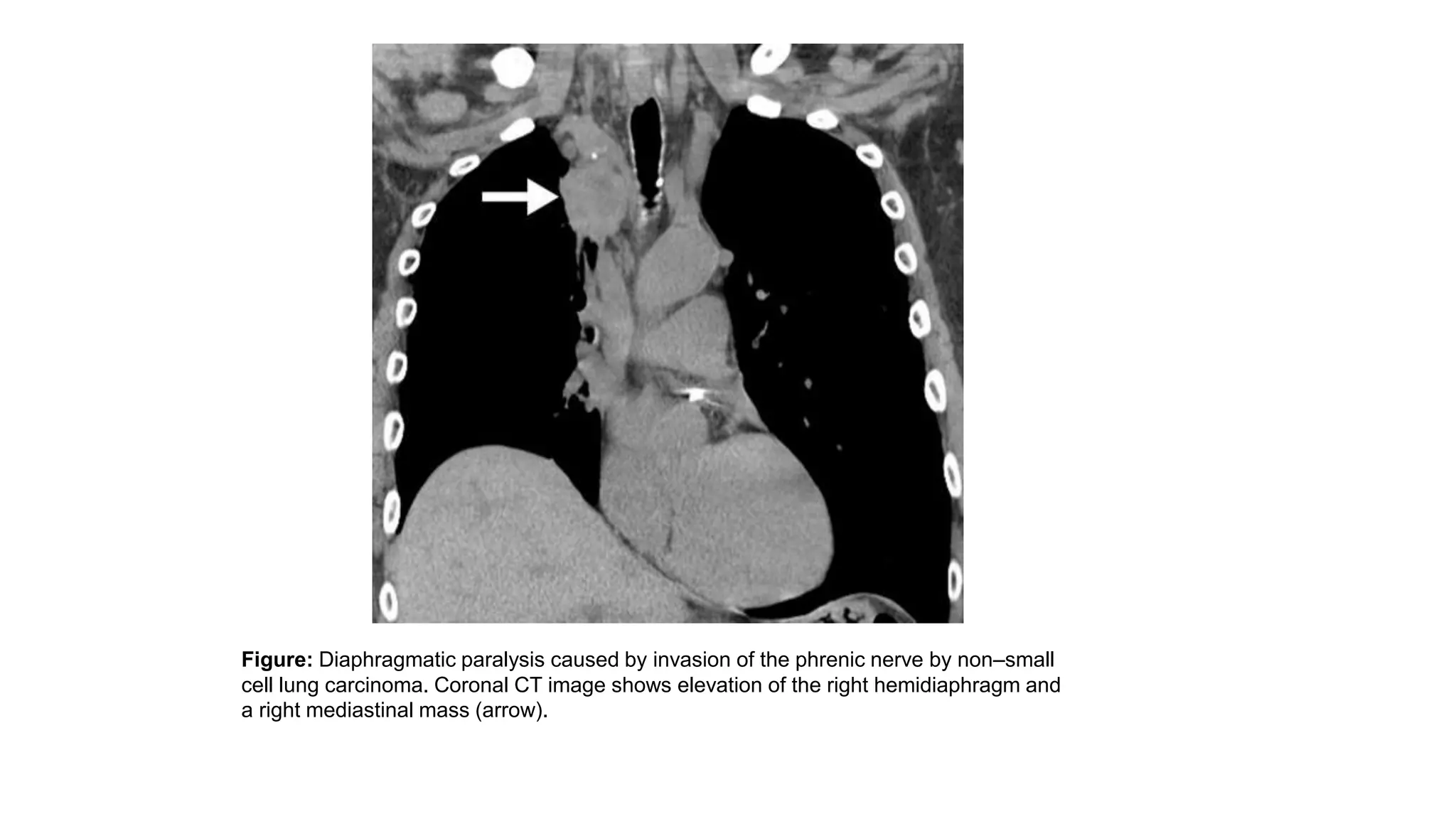 Imaging of diaphragm and its pathologies by Dr. Milan | PPTX