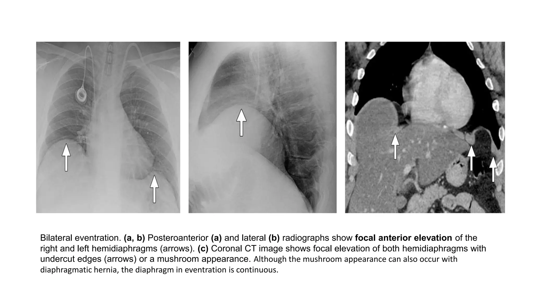Imaging of diaphragm and its pathologies by Dr. Milan | PPTX