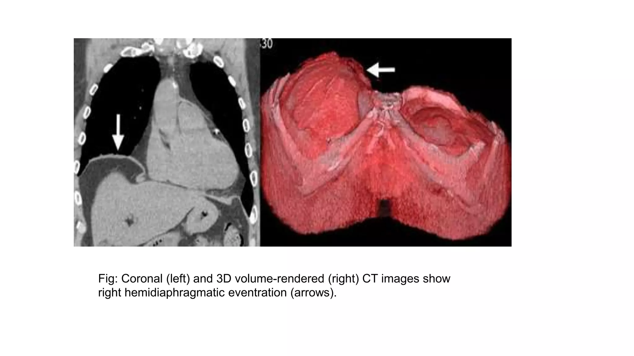 Imaging of diaphragm and its pathologies by Dr. Milan | PPTX