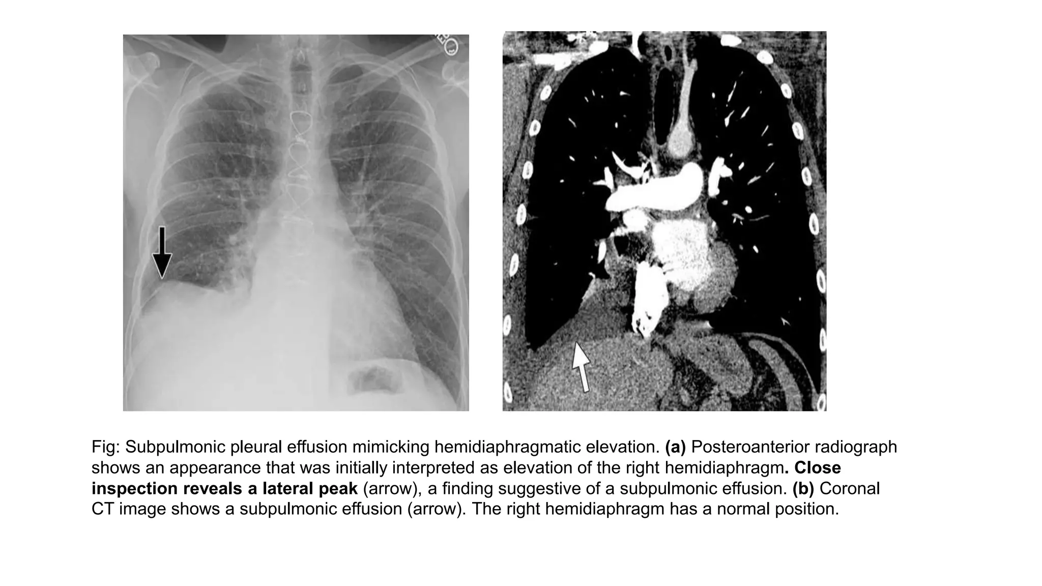Imaging of diaphragm and its pathologies by Dr. Milan | PPTX
