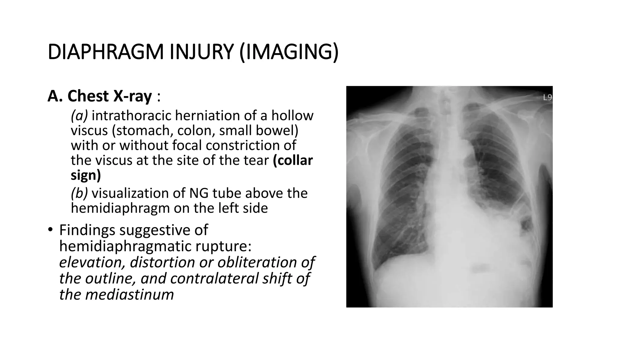Imaging of diaphragm and its pathologies by Dr. Milan | PPTX