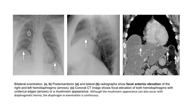 Imaging of diaphragm and its pathologies by Dr. Milan | PPTX