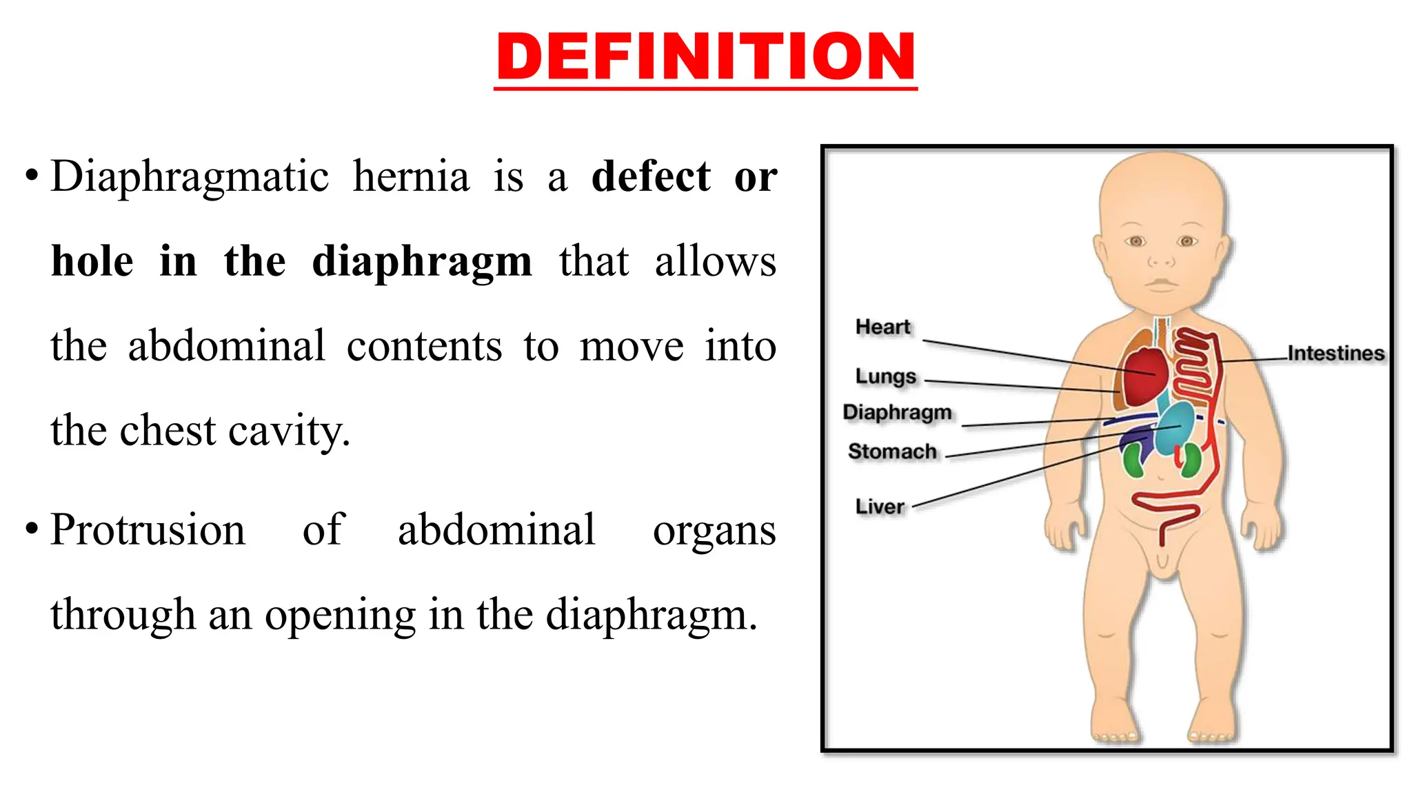 DIAPHRAGMATIC HERNIA.pptx
