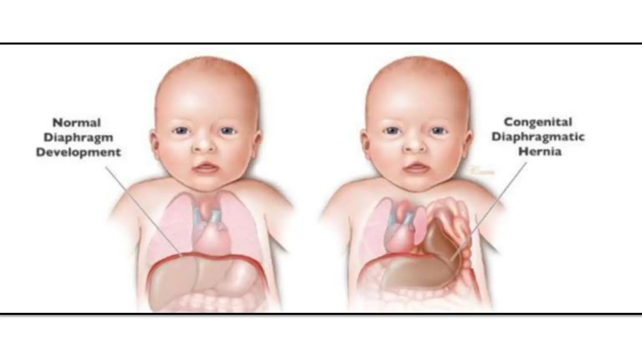 DIAPHRAGMATIC HERNIA .pptx
