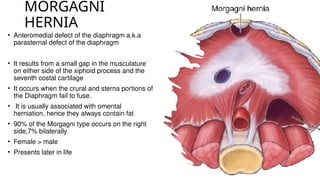 Overview on Diaphragmatic hernia presentation | PPTX