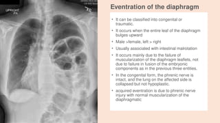 Overview on Diaphragmatic hernia presentation | PPT