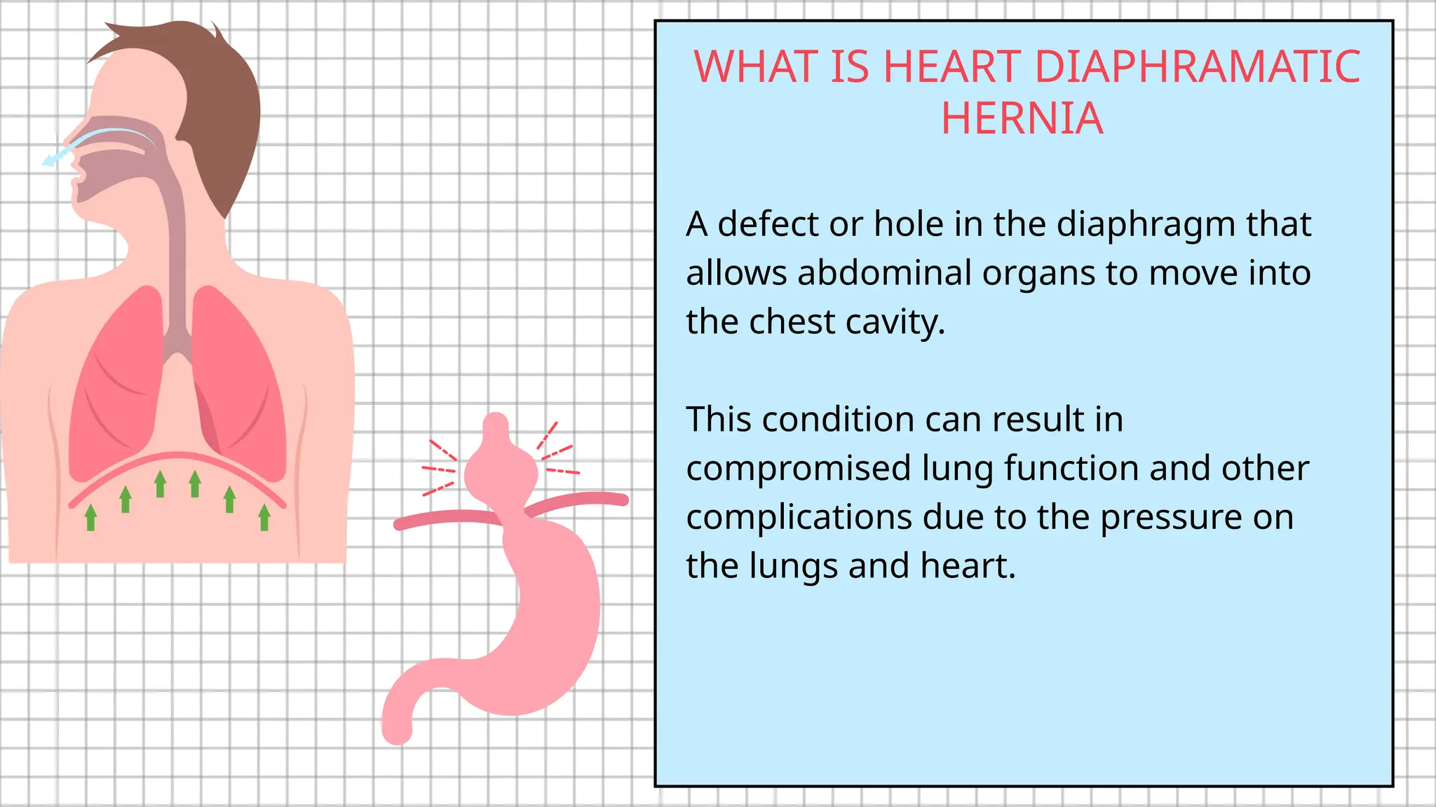 Diaphragmatic Hernia: Understanding the Anatomy, Diagnosis, and ...