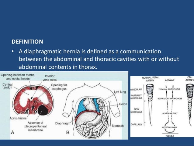 Diaphragmatic hernia