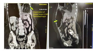 diaphragmatic hernia final ppt.pptx