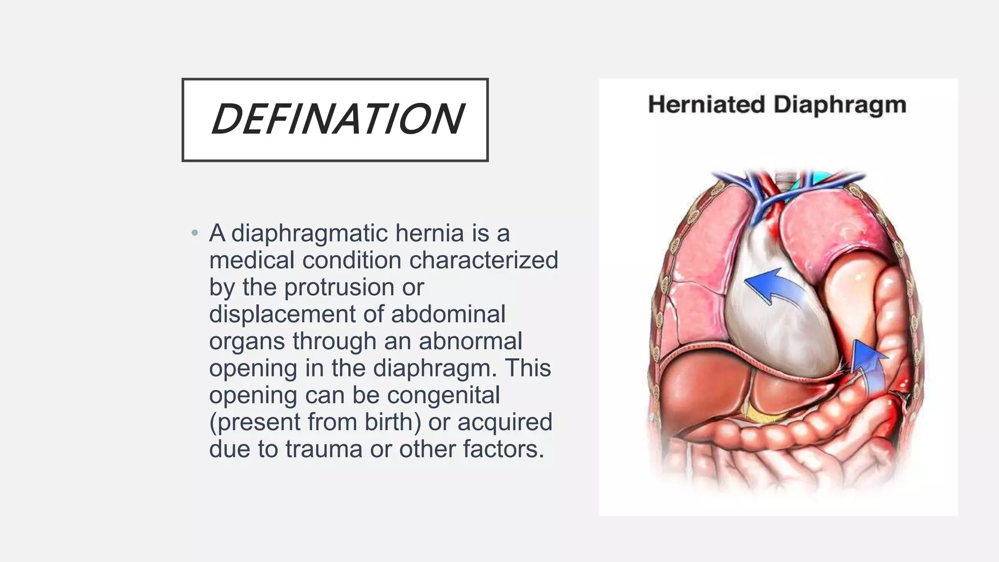 Diaphragmatic HERNIA REPAIR.pptx