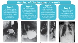 Diaphragmatic Hernia revised. Criteriapptx | PPT