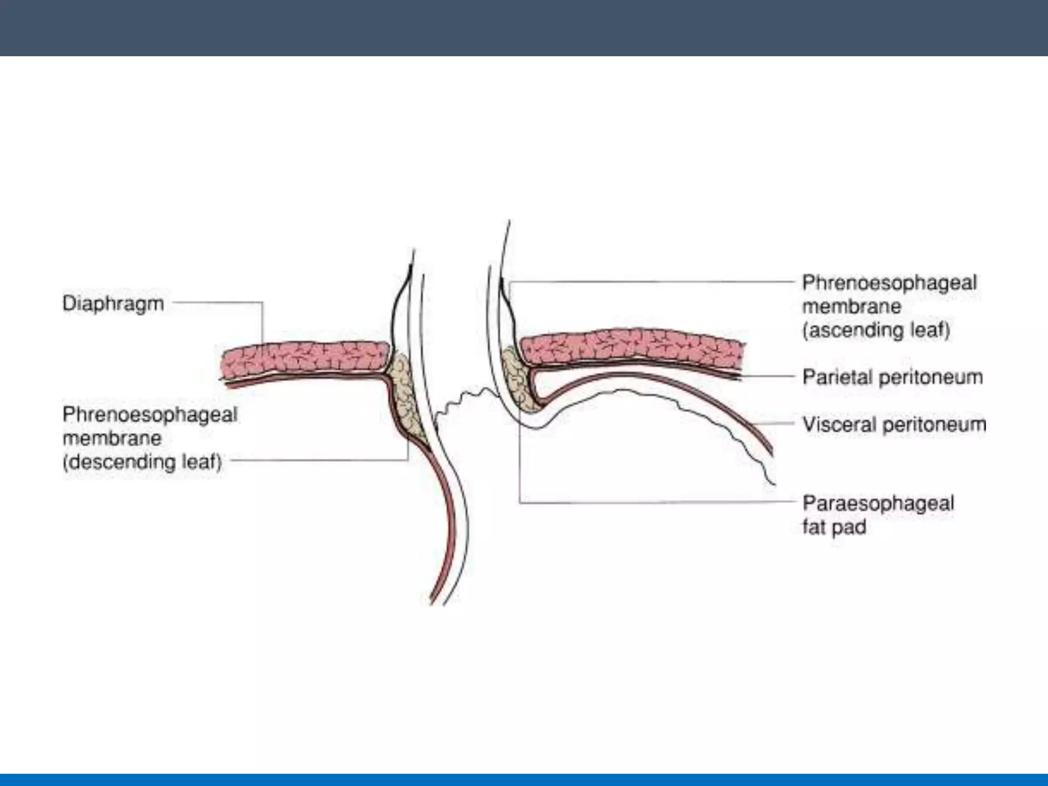 Hiatal hernia, types and management | PPTX