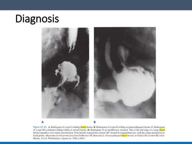 Hiatal hernia, types and management | PPTX