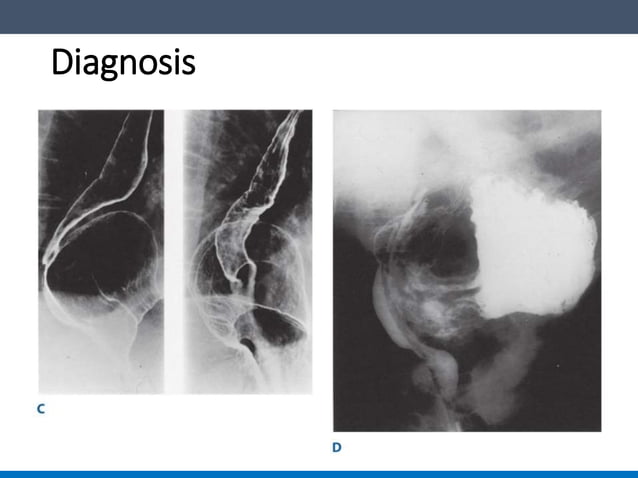 Hiatal hernia, types and management | PPTX