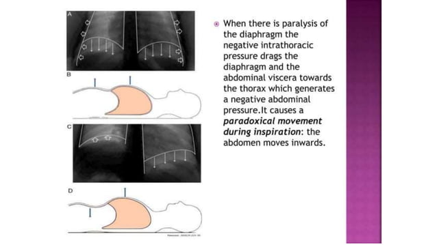 Diaphragm disorder Dr Kantam Chakraborthy disorders.pptx