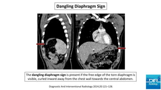 Diaphragmatic Injuries - Radiology Reading Room | PPTX