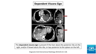 Diaphragmatic Injuries - Radiology Reading Room | PPTX
