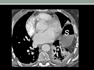 Imaging of Diaphragmatic rupture | PPTX