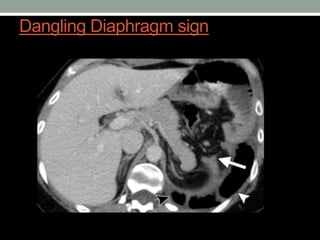 Imaging of Diaphragmatic rupture | PPTX