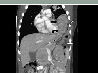 Imaging of Diaphragmatic rupture | PPTX