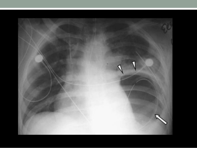 Imaging of Diaphragmatic rupture