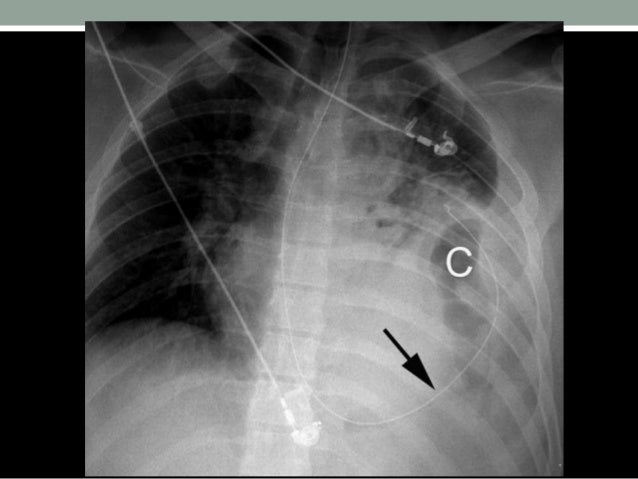 Imaging of Diaphragmatic rupture