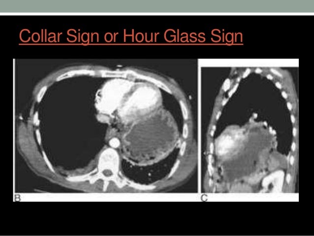 Imaging of Diaphragmatic rupture
