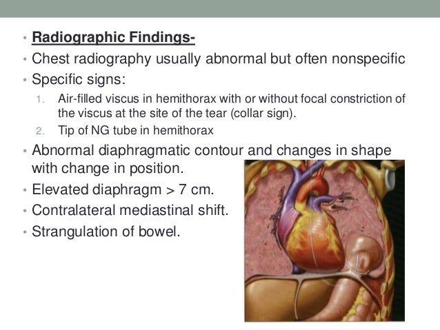 Imaging of Diaphragmatic rupture