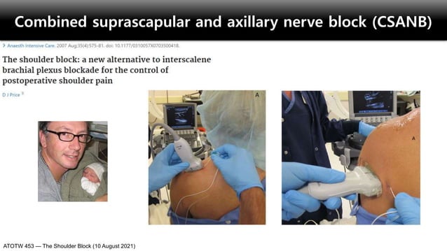 Diaphragm sparing nerve blocks for shoulder surgery | PPTX | Death ...