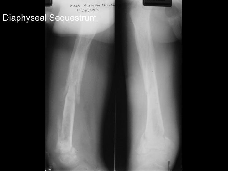 Diaphyseal Sequestrum