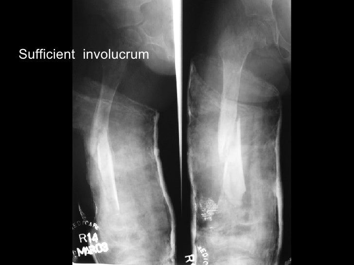 Diaphyseal Sequestrum