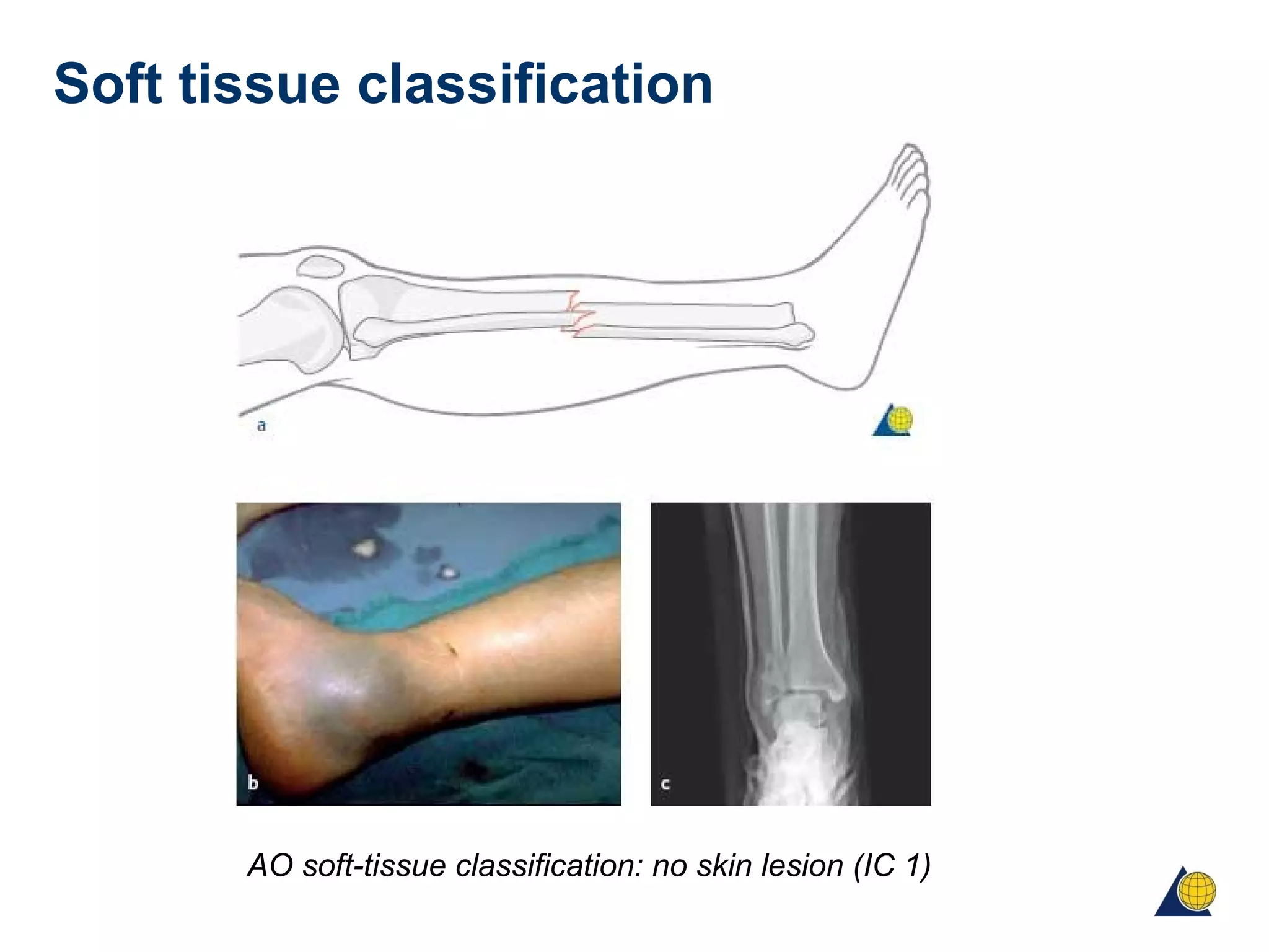 Diaphyseal (tibia and femur) fractures | PPT