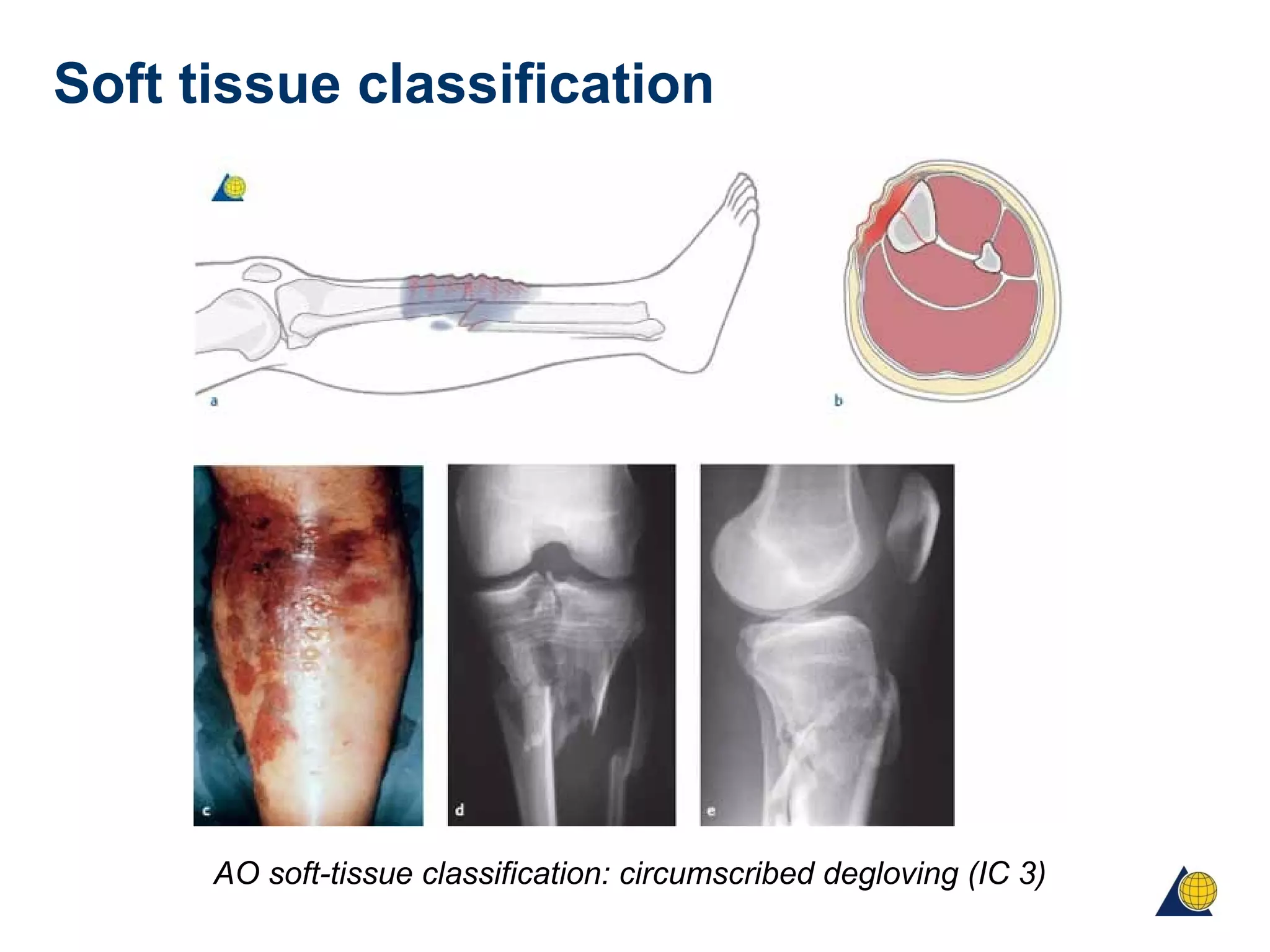 Diaphyseal (tibia and femur) fractures | PPT