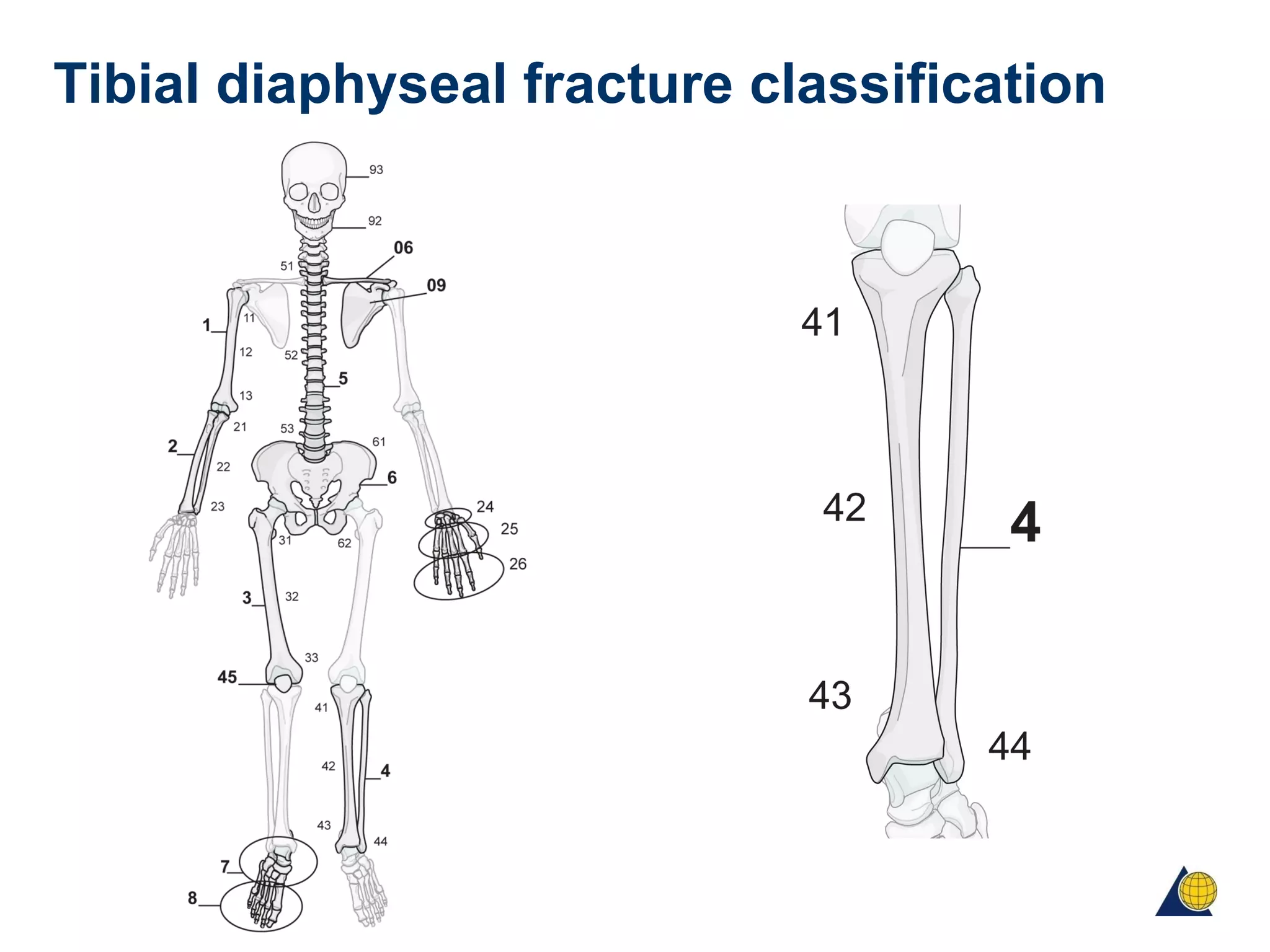 Diaphyseal (tibia and femur) fractures | PPT