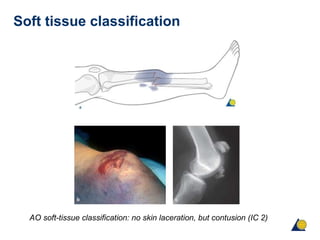 Diaphyseal (tibia and femur) fractures | PPT
