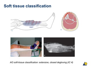 Diaphyseal (tibia and femur) fractures | PPT