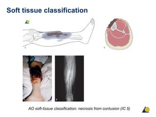 Diaphyseal (tibia and femur) fractures | PPT