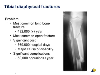 Diaphyseal (tibia and femur) fractures | PPT