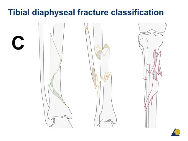 Diaphyseal (tibia and femur) fractures