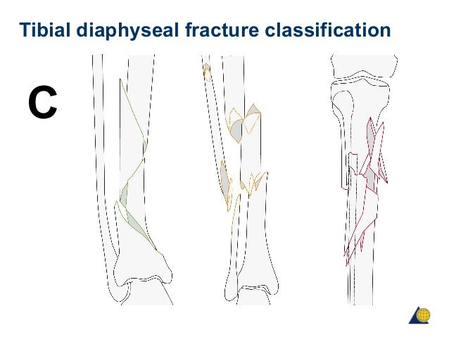 Diaphyseal (tibia and femur) fractures