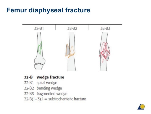 Diaphyseal (tibia and femur) fractures