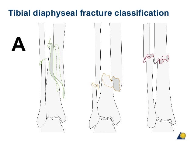Diaphyseal (tibia and femur) fractures